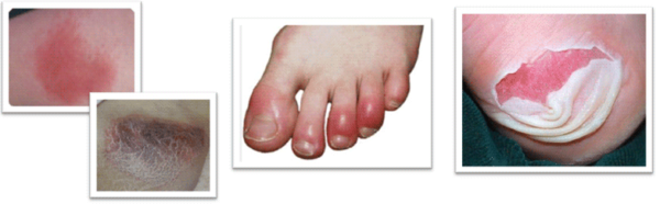 Pressure Ulcers | Swan Medical Group